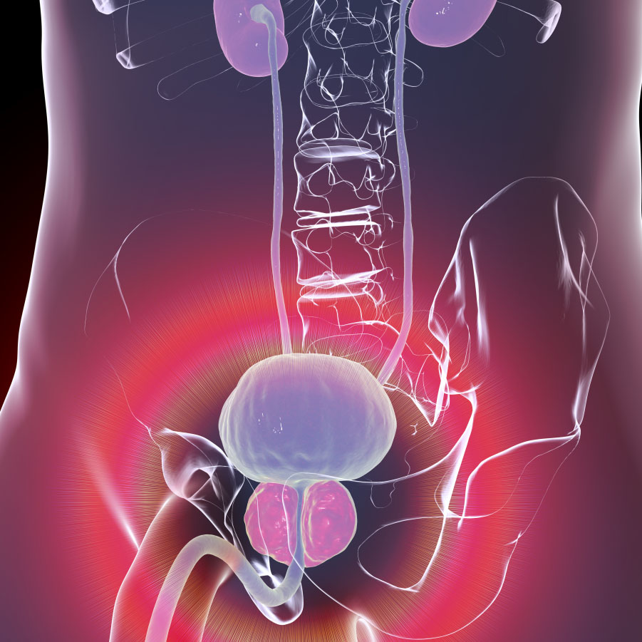 China Prostate Cancer Product and Supplier | Southoncology